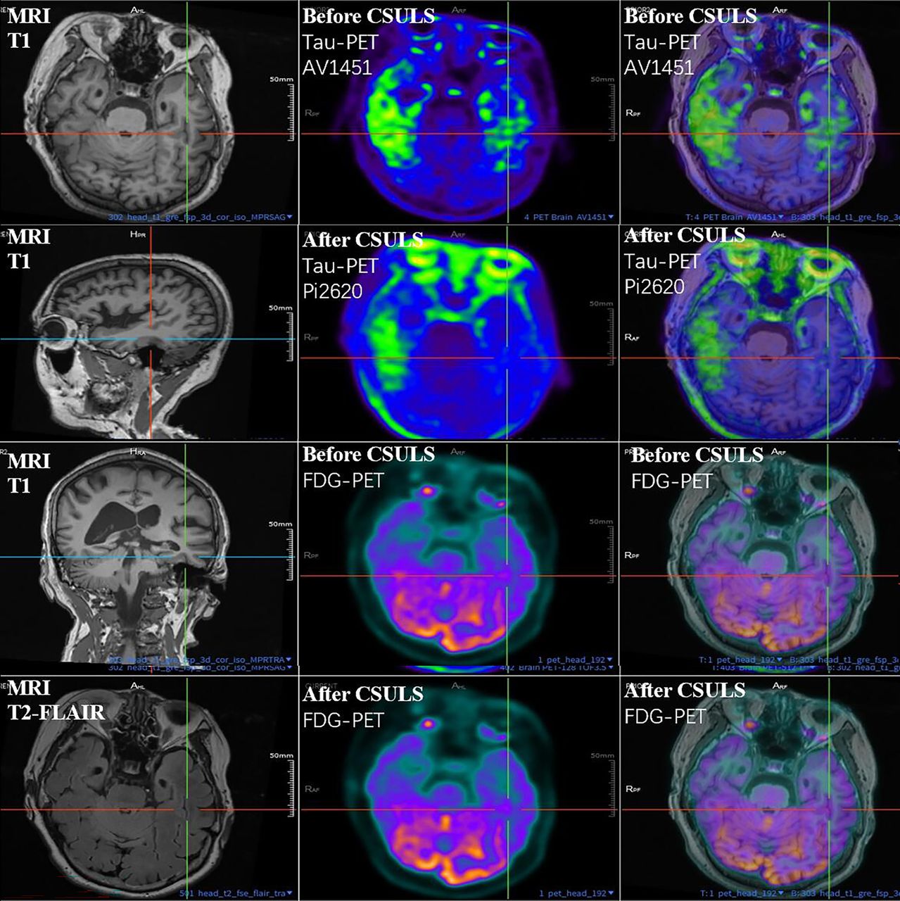 Promising outcomes 5 weeks after a surgical cervical shunting procedure ...